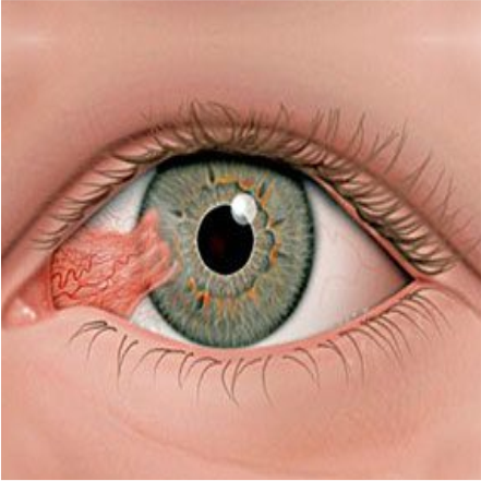 Cuida tus ojos de las carnosidades oculares - Dr. David Méndez